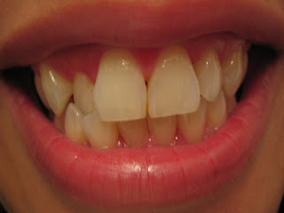 Thy's Invisalign Journey: 7th Trays