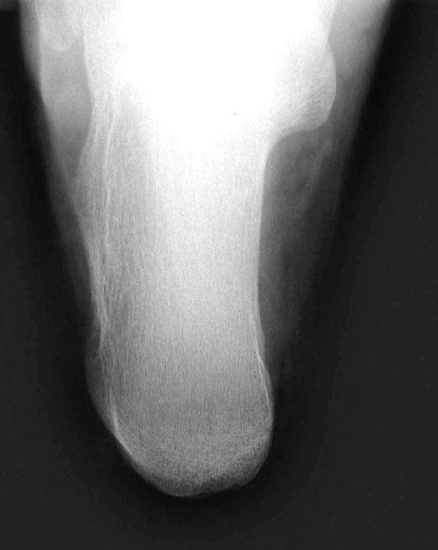 CALCANEOMAN: Axial de calcaneo
