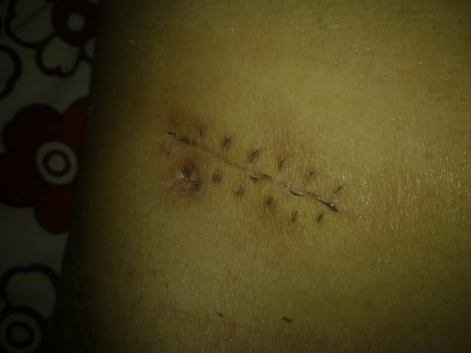 ♥ Daphenie Tan ♥: The most sadness scar i got ...