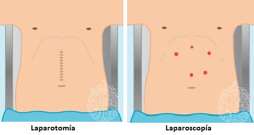 Laparotomía