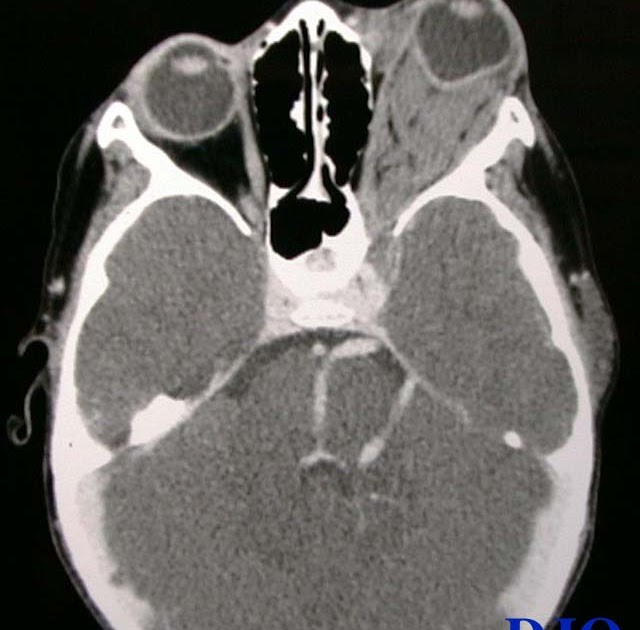 CT and MRI Blog: Orbital Cellulitis