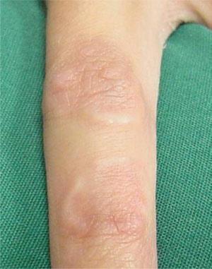 Persian Medical Group: Phototherapy & Photochemotherapy Ward of Razi ...