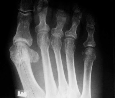 O Radiologista: Hálux Valgo