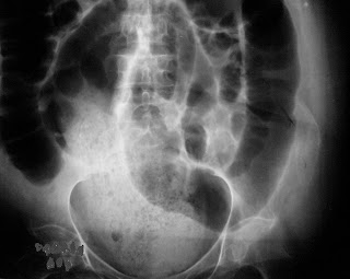 O Radiologista: Fecaloma