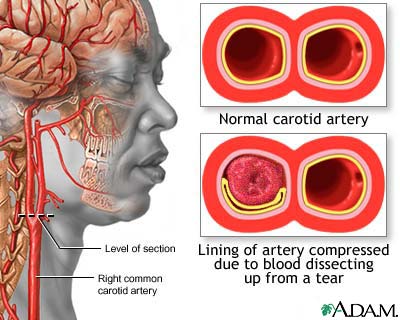 Megan's CT/MRI Pathology: Dissection of Carotid Artery