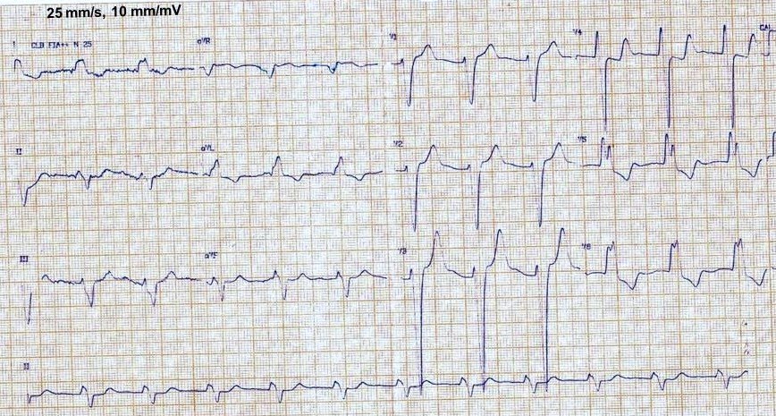 Blog de Eletrocardiografia: ECG COM DISCUSSÃO 3