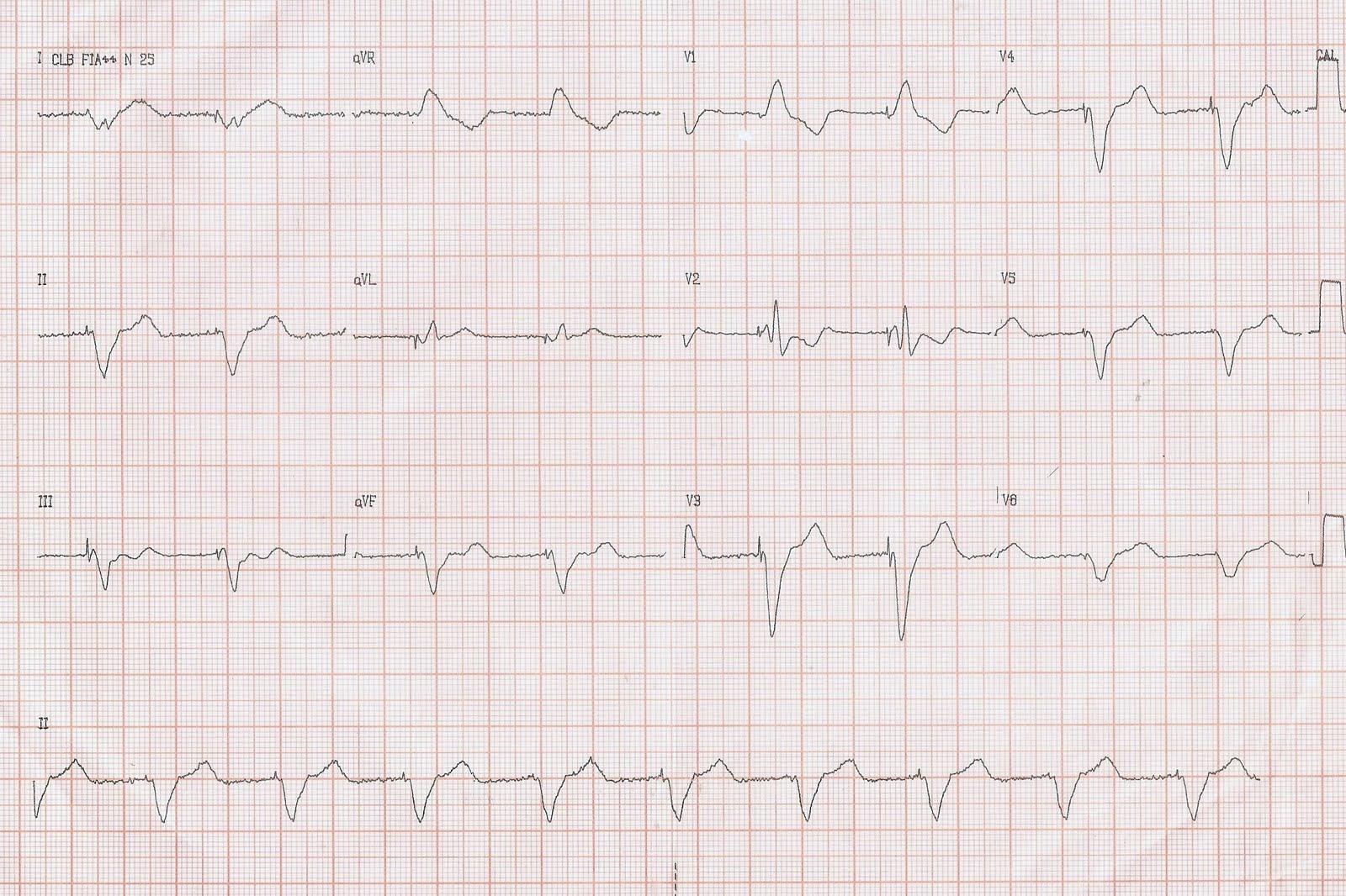 Blog de Eletrocardiografia: MARCAPASSO PROVISÓRIO