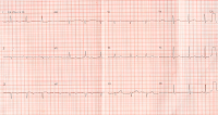 Blog de Eletrocardiografia: QUAL É O DIAGNÓSTICO 9?