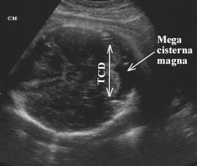 MEGA SİSTERNA MAGNA | Jinekoloji Gebelik Hesaplama