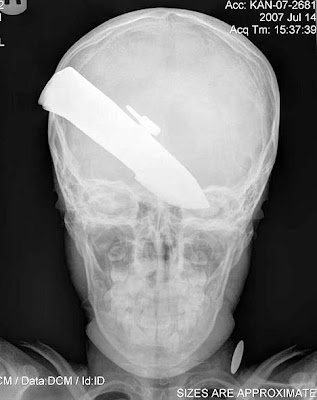 Quigley's Cabinet: Traumatic skull injuries