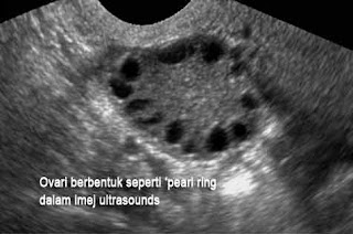 MIDORI Bunsay: PCOS - polycystic ovarian syndrome