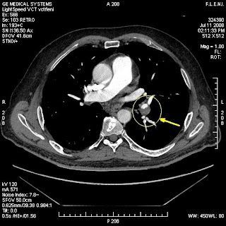 Sobre técnicas de imágenes médicas (Blog STIM): Tromboembolismo ...
