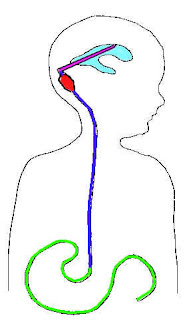 VALVULA DE HAKIM.: Hidrocefalia.