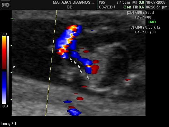 DR.ARUN MAHAJAN: TWIN WITH ACARDIA