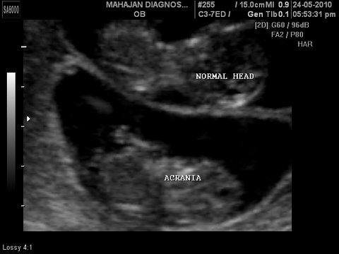 DR.ARUN MAHAJAN: TWIN WITH ACRANIA IN ONE