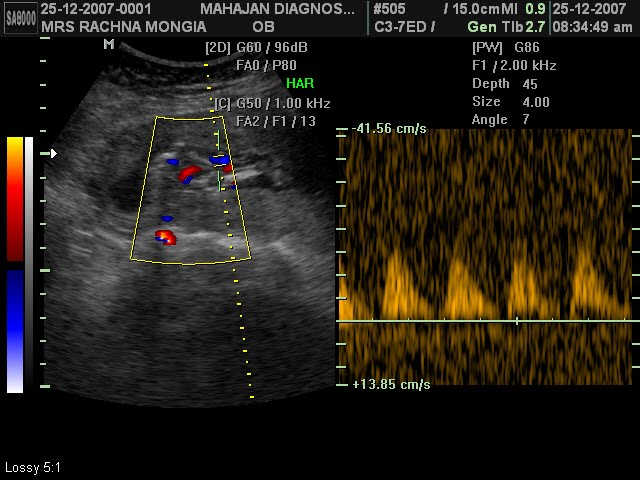 DR.ARUN MAHAJAN: ABSENT DIASTOLIC FLOW WITH OLIGO