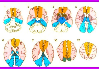 Jerence Blog: cva artery