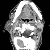 CT Pathology Blog: Malignant Parotid Tumor