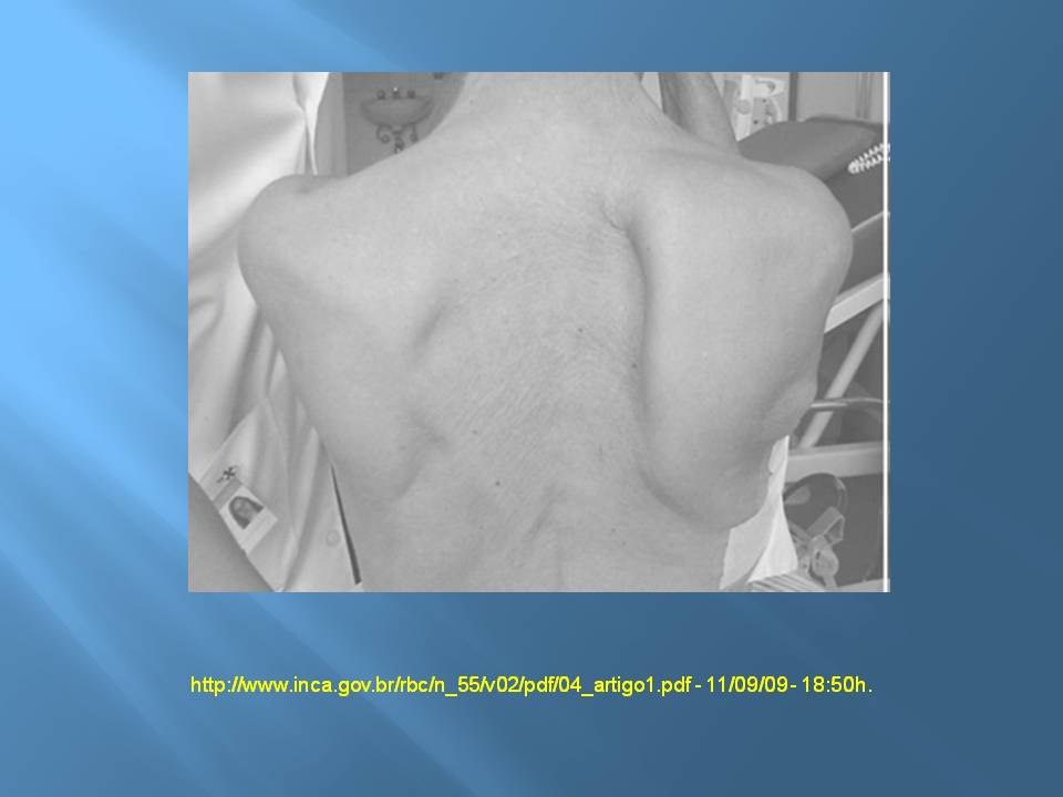 Professor Nelson: Escápula Alada