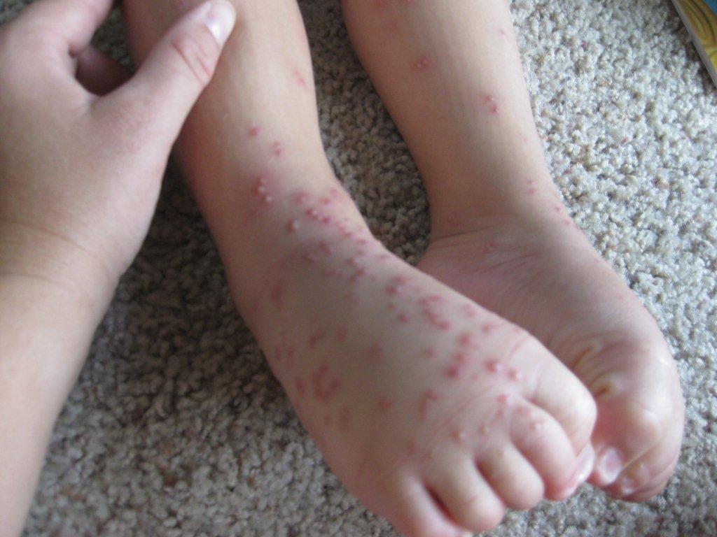 minorhappenings: Ant Bites - Day 2: We went to the Doctor