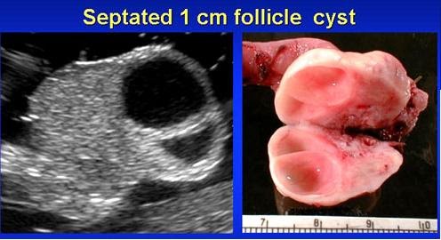 Holistic Medicine and Holistic Healing: The Nature of Septated Ovarian ...