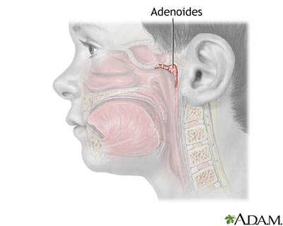 Pediatria Em Dia: Cirurgia de amígdalas e adenóides: quando indicá-las?