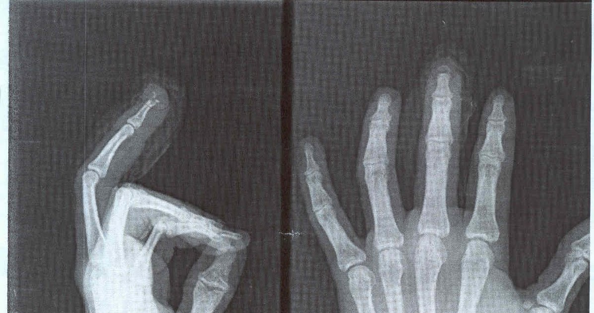 melancoholismo: Falange distal, 3º dedo, mano izquierda.