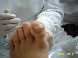 Podología Clinica Lo Vial: Exostosis Primer Ortejo pie Izquierdo zona ...