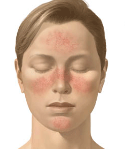 ITCHY HIVES ON SKIN: Rashes on the Face and Infections