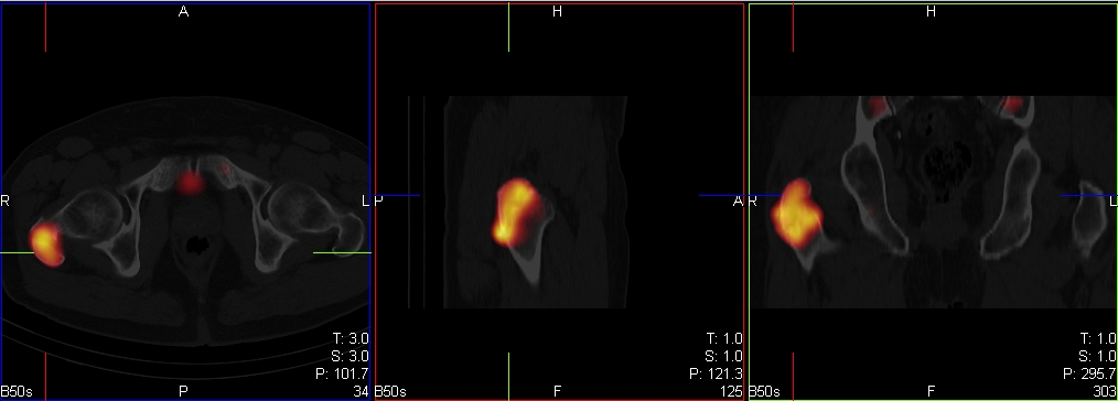 Nuclear Medicine & PET: Bone Scan
