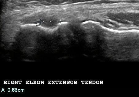 BloodCure from Dare To Be Vital: Ultrasound and Platelet Rich Plasma