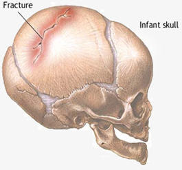 Skull, cranium pain - Causes and treatment for skull Pain