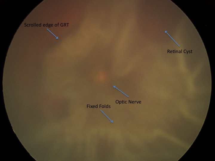 Pediatric Retina: Stickler Syndrome -Part 1