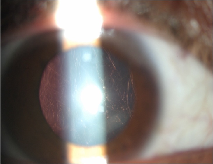 Pediatric Retina: Stickler Syndrome-Part 3 (Photographic Collection)