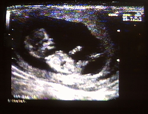 Free Advice from Breastmates: 13 Week Baby Scan