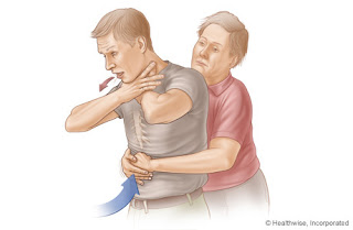 Heimlich Maneuver... - NEJS
