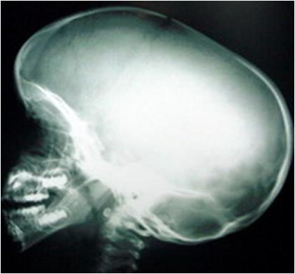 Craneosinostosis: Craneosinostosis