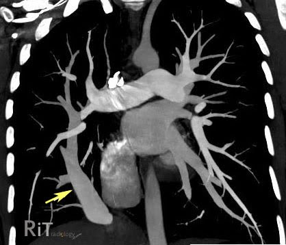 RiT radiology: Scimitar Syndrome