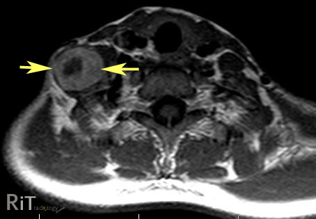 RiT radiology: Primary Brachial Plexus Tumor