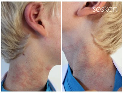 SØSKEN: Eksem oppbluss på problemområder