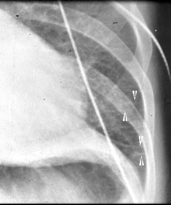 Medic Guide: What are Kerley B lines?