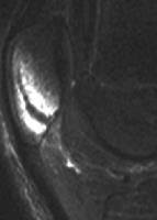 Kathy's MRI Pathology Blog: Patella Fracture / Knee Pathology