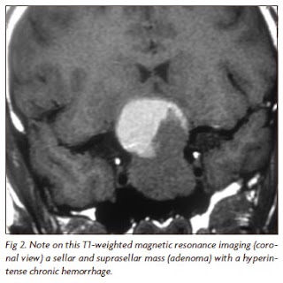 Kathy's MRI Pathology Blog: Pituitary Apoplexy