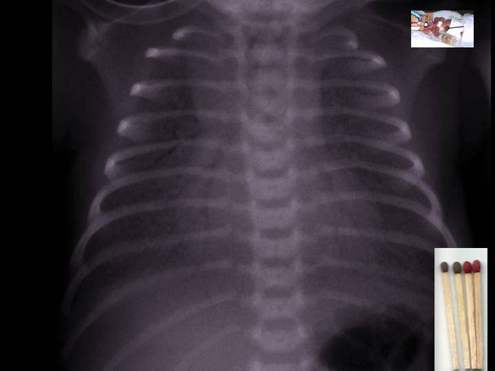 Grading of Respiratory Distress Syndrome ~ medik-ukm