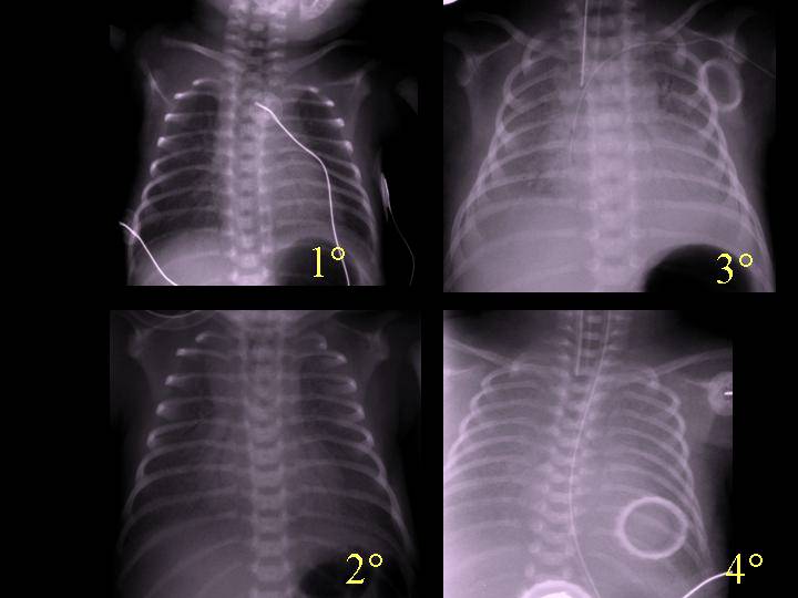 Grading of Respiratory Distress Syndrome ~ medik-ukm