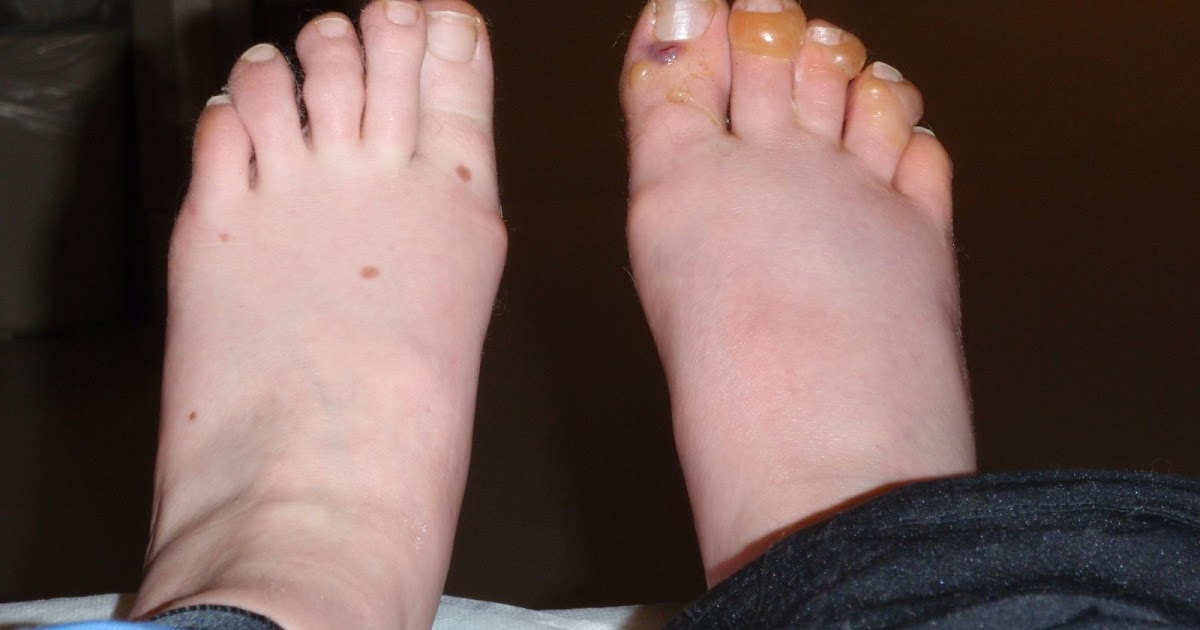 Jill Outside: Frostbite