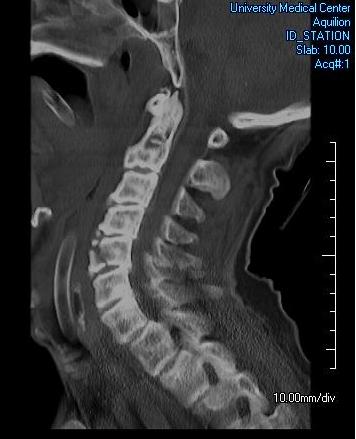 University of Toledo Radiology: Flexion Teardrop Fracture of C5