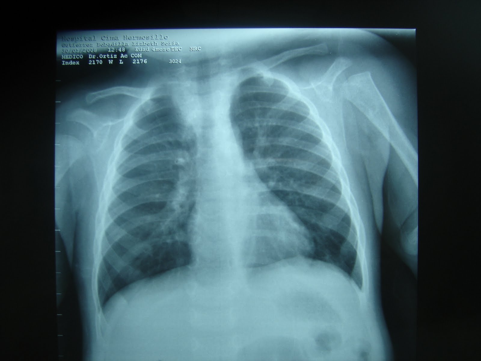 CASO CLINICO: Bronquiolitis-Miocardiopatia Dilatada
