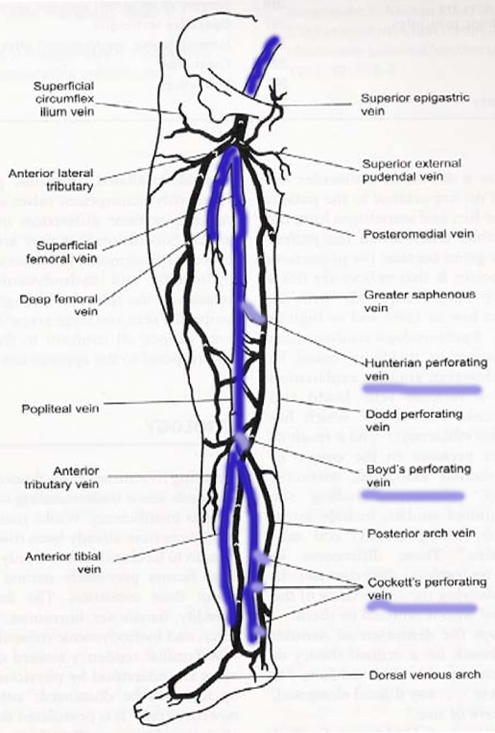 Ekstremite venöz anotomi, Kronik venöz yetmezlik