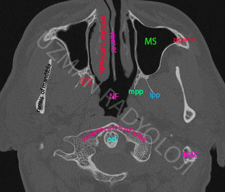 TEMPORAL KEMİK(TEMPORAL BONE) - KAFA TABANI (SKULL BASE) ANATOMİSİ